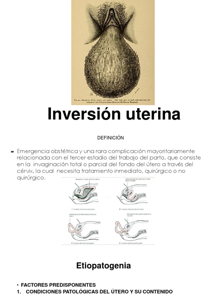 Inversion Uerina | PDF | Útero | Parto