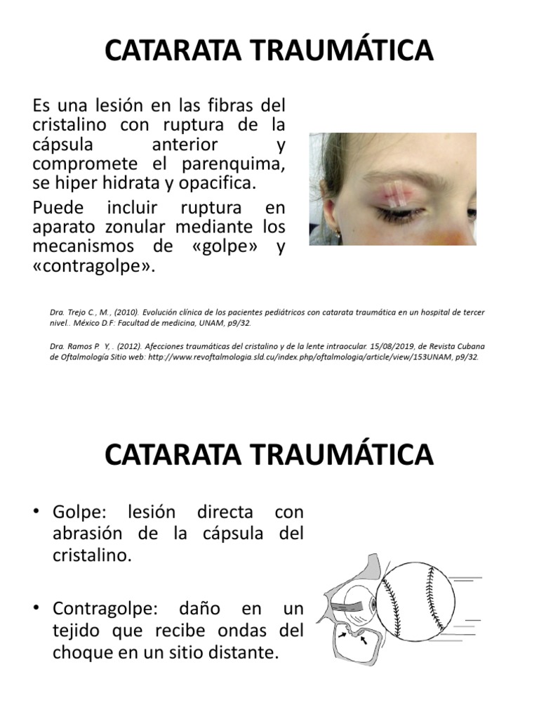 Catarata traumática: causas, síntomas y tratamiento | PDF | Catarata ...