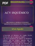 Escala ASPECTS | PDF