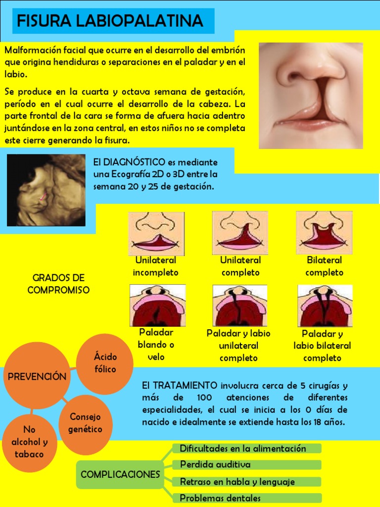 Fisura Labio Palatina | PDF