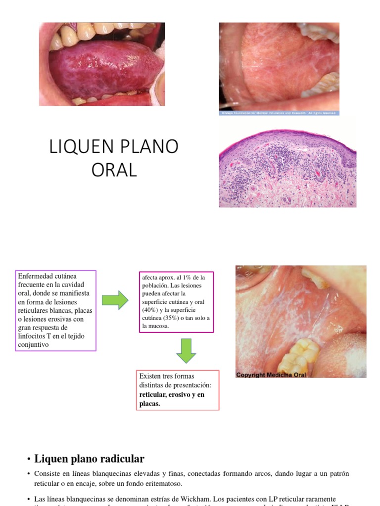 Liquen Plano | PDF | Lupus eritematoso sistémico | Epitelio