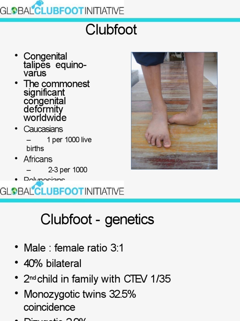 Clubfoot: - Congenital Talipes Equino-Varus - The Commonest Significant ...