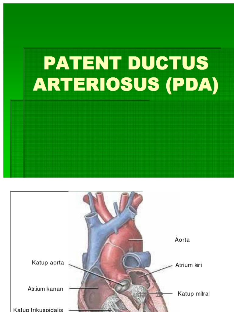 Patent Ductus Arteriosus Ok | PDF
