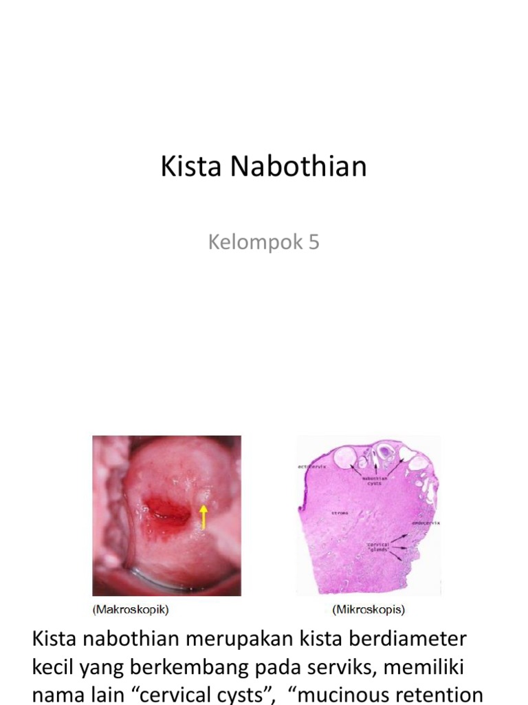 Kista Nabothian: Penyebab dan Penanganan | PDF