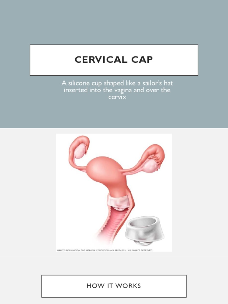 Cervical Cap A Silicone Cup Shaped Like A Sailors Hat Inserted Into