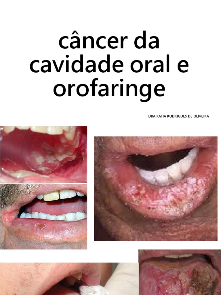 Câncer Da Cavidade Oral | PDF | Boca | Higiene bucal