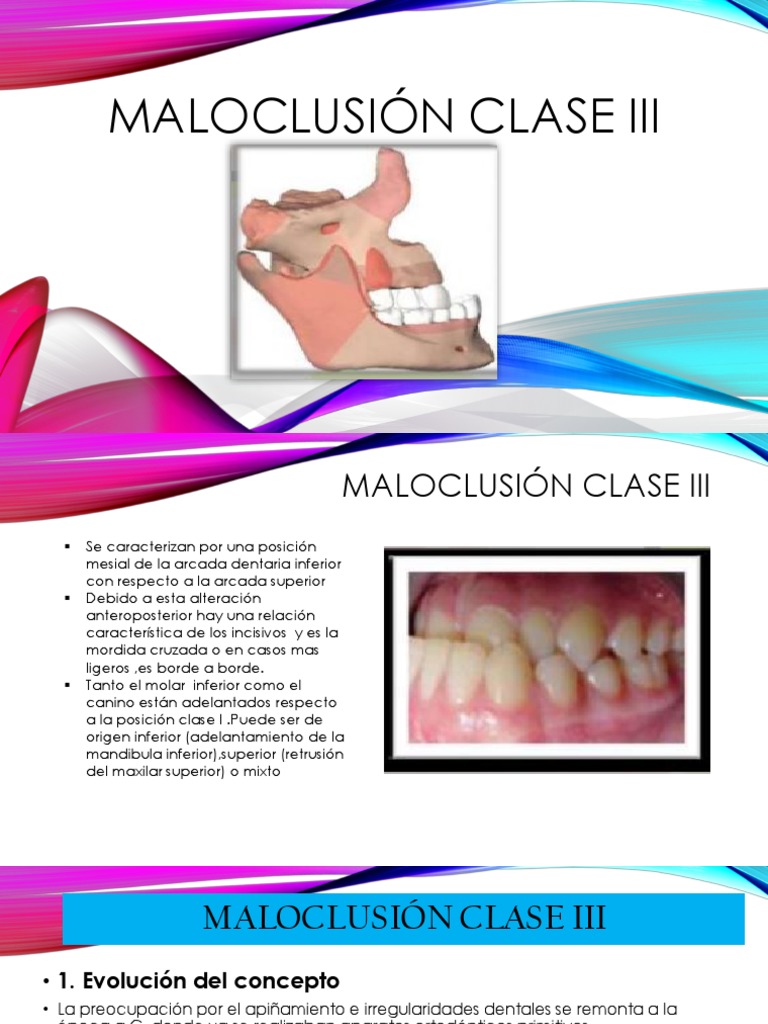 Maloclusión Clase III: Características y Tratamiento | PDF | Ortodoncia ...