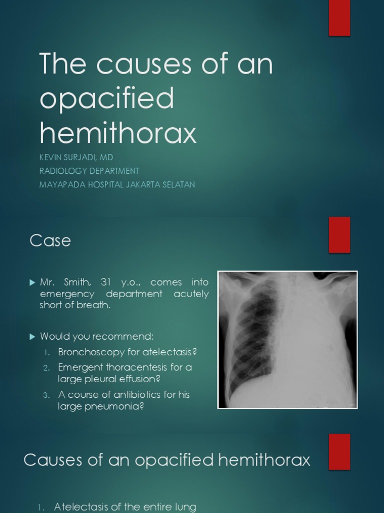The Causes of An Opacified Hemithorax - Kevin | PDF | Lung ...