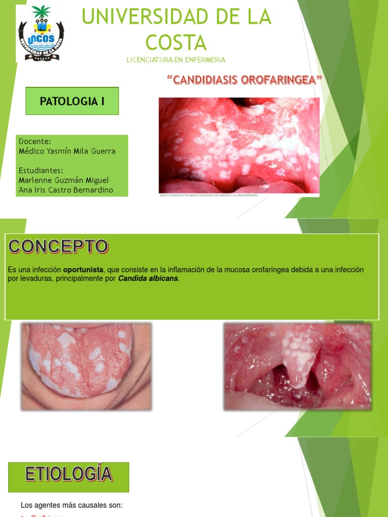 Candidiasis Orofaringea Corregida | PDF | Candidiasis | Medicina