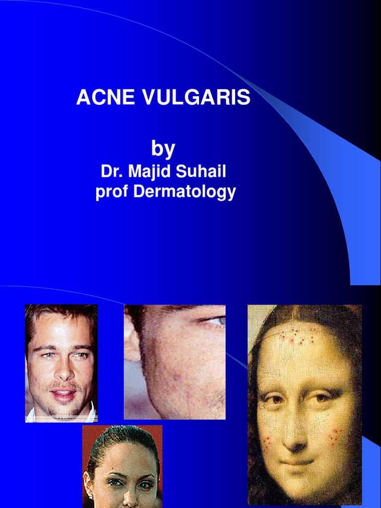 Acne Vulgaris By: Dr. Majid Suhail Prof Dermatology | PDF | Dermatology ...