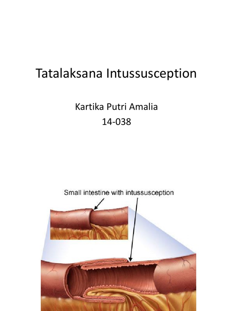 Tatalaksana Intussusception pada Anak | PDF