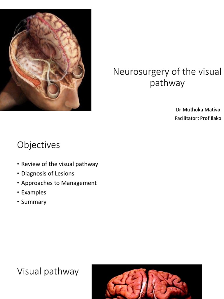 Neurosurgery of The Visual Pathway | PDF | Nervous System | Clinical ...