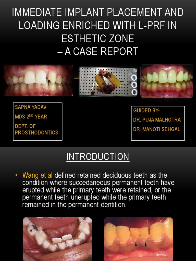Immediate Implant Placement and Loading Enriched With L-PRF in Esthetic ...