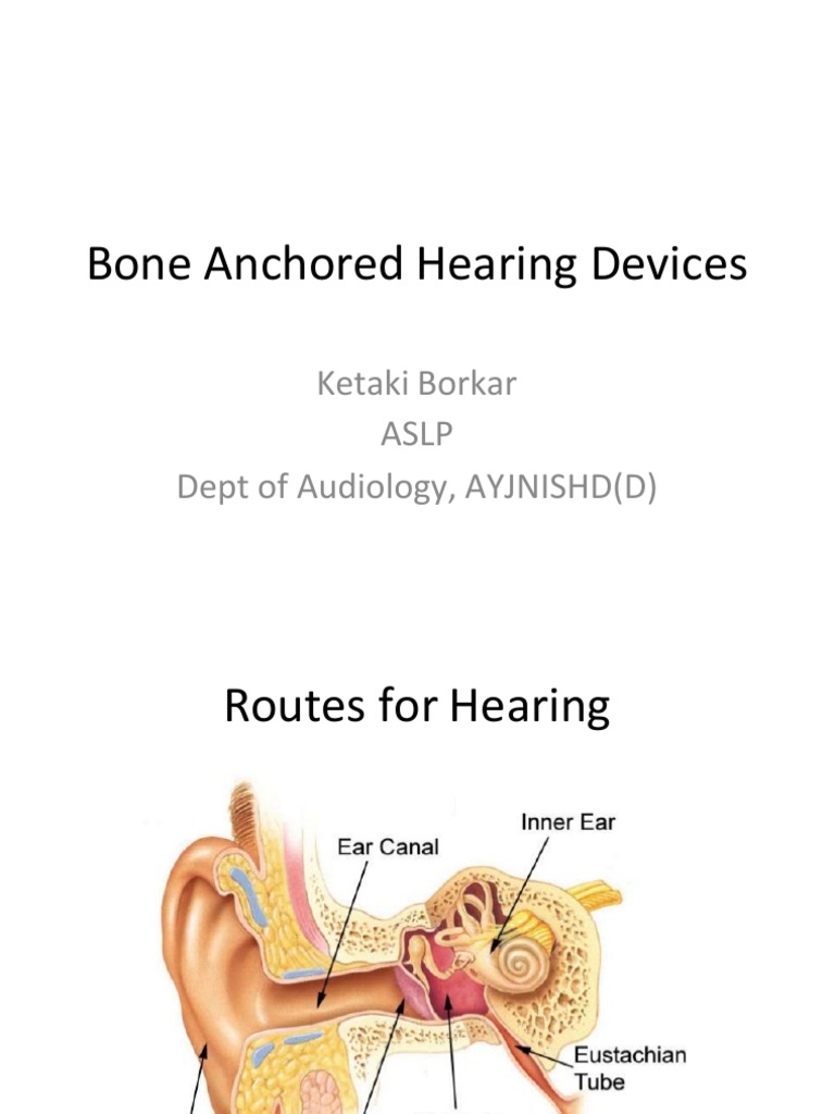 Bone Anchored Hearing Devices: Ketaki Borkar Aslp Dept of Audiology ...