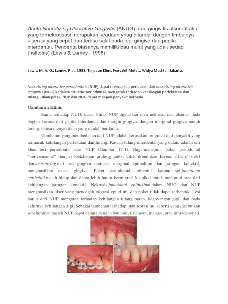 Acute Necrotizing Ulcerative Gingivitis | PDF