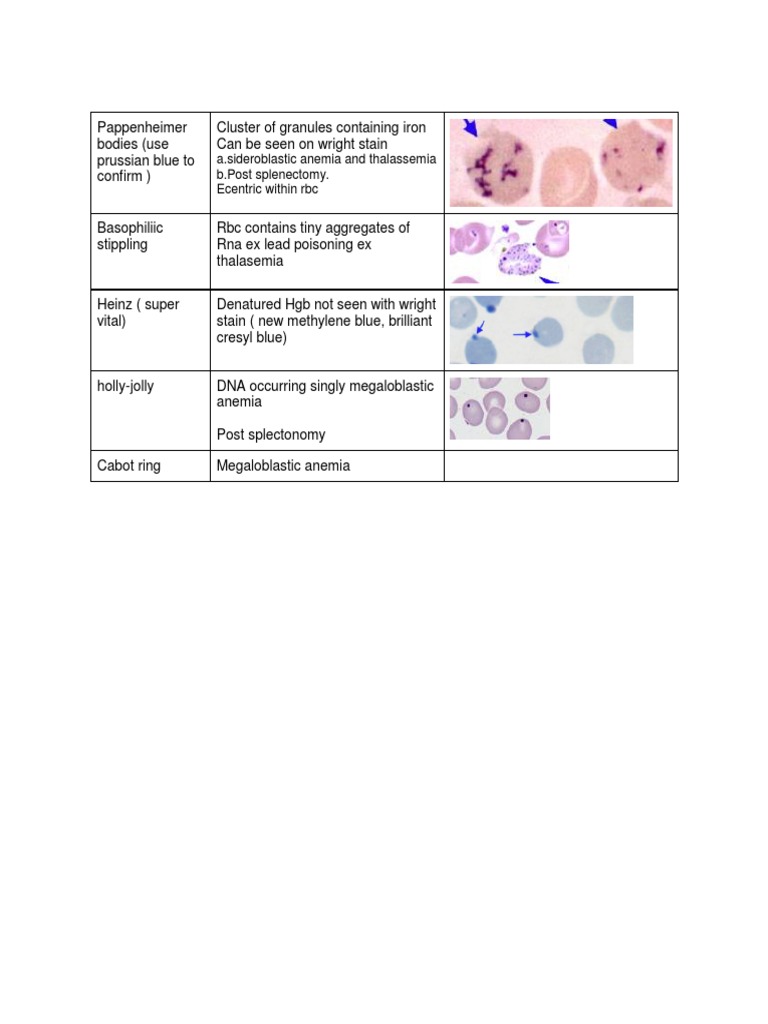 A.sideroblastic Anemia and Thalassemia B.post Splenectomy. Ecentric ...