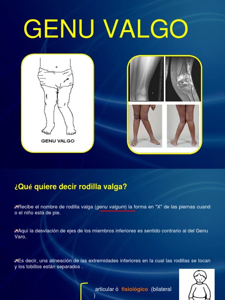 Genu Valgo 1 | PDF | Rodilla | Anatomía del miembro inferior