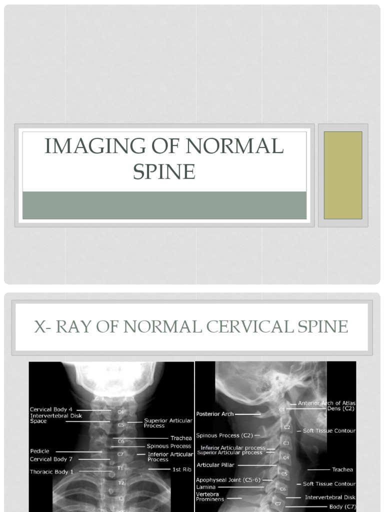 Vertebrae | PDF | Ct Scan | Radiology