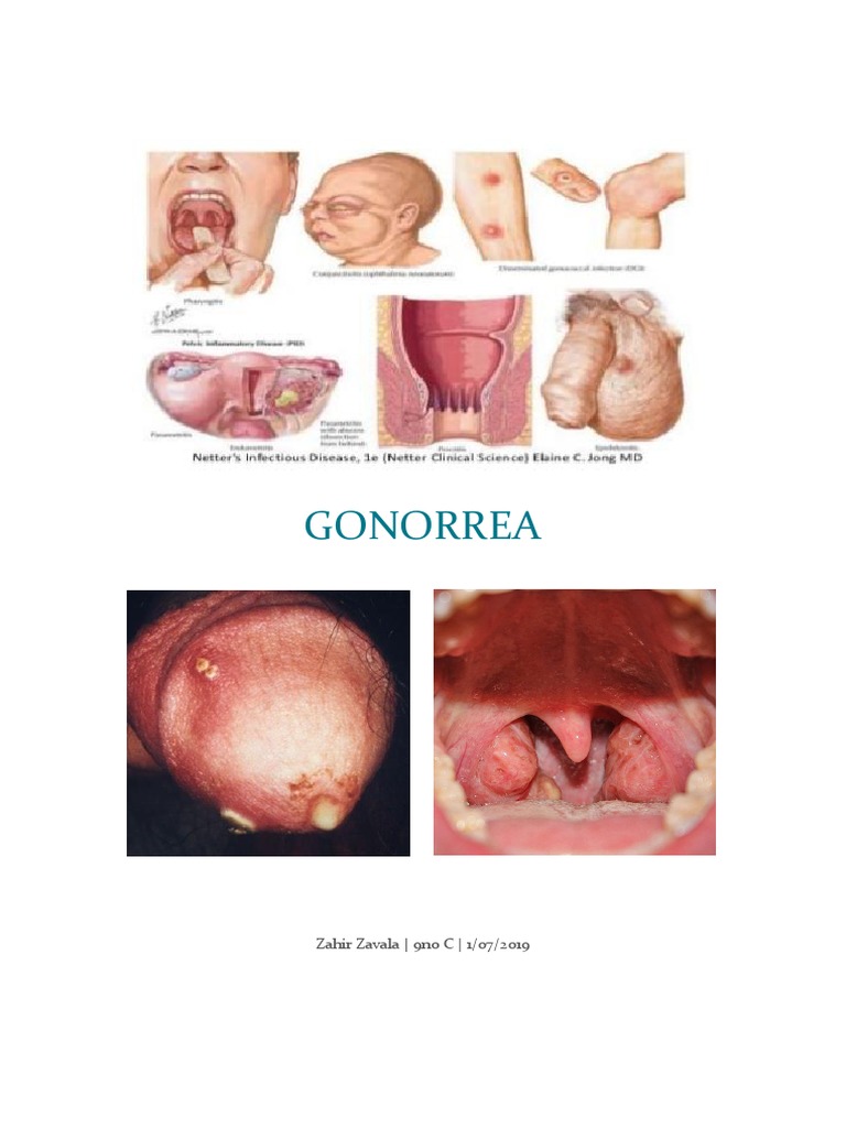 Gonorrea | PDF | Especialidades Medicas | Enfermedades y trastornos