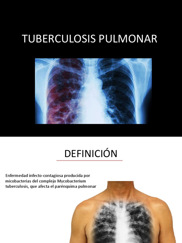 Tuberculosis Pulmonar | PDF | Tuberculosis | Medicina CLINICA