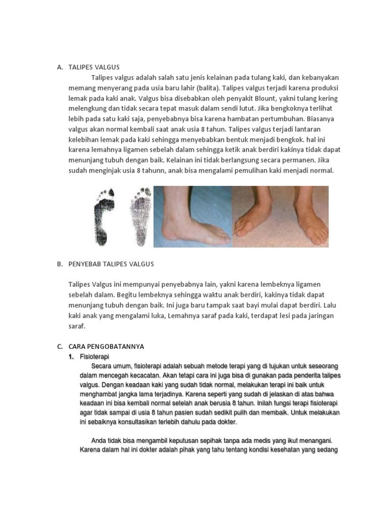 Talipes Valgus | PDF