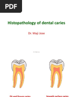 Keyes Triad of Dental Caries | PDF