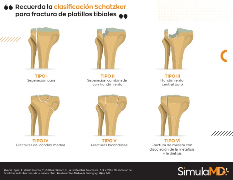 Clasificación Schatzker para Fractura de Platillos Tibiales | PDF