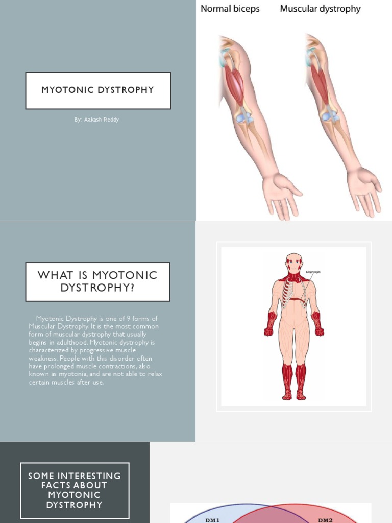 An In-Depth Look at Myotonic Dystrophy: Causes, Symptoms, Inheritance ...