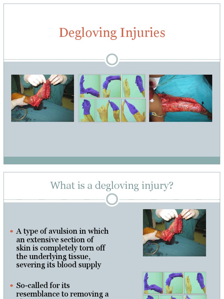 Degloving Injuries | Download Free PDF | Wound | Clinical Medicine