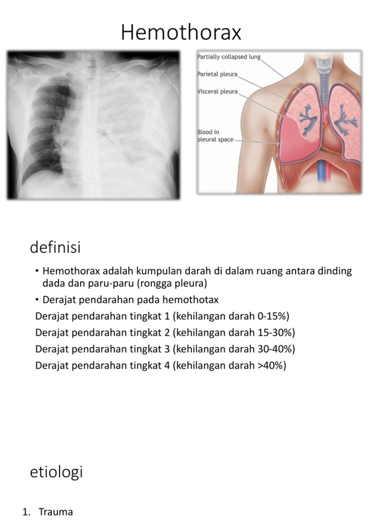 Hemothorax | PDF