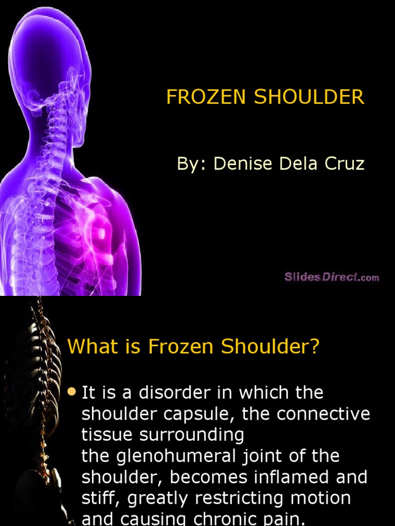 Frozen Shoulder: By: Denise Dela Cruz | PDF | Shoulder | Human Anatomy