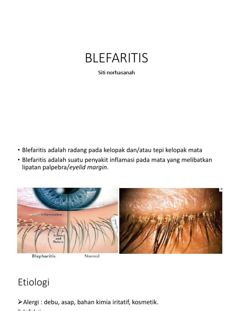 BLEFARITIS | PDF