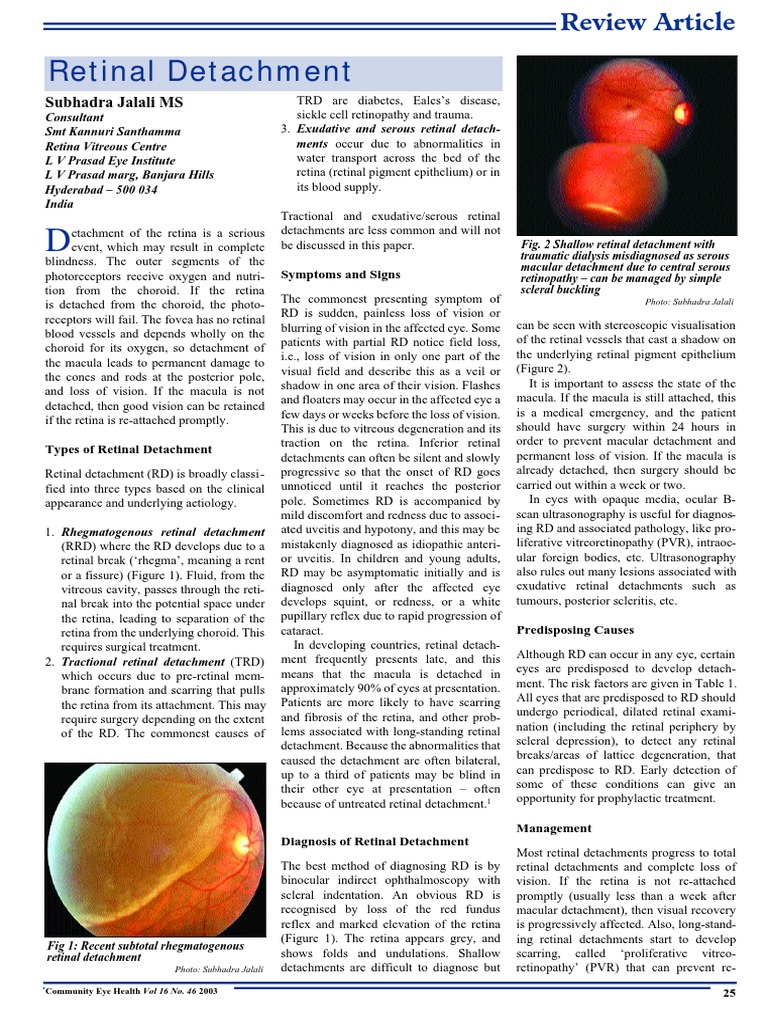 Retinal Detachment | PDF | Retina | Eye