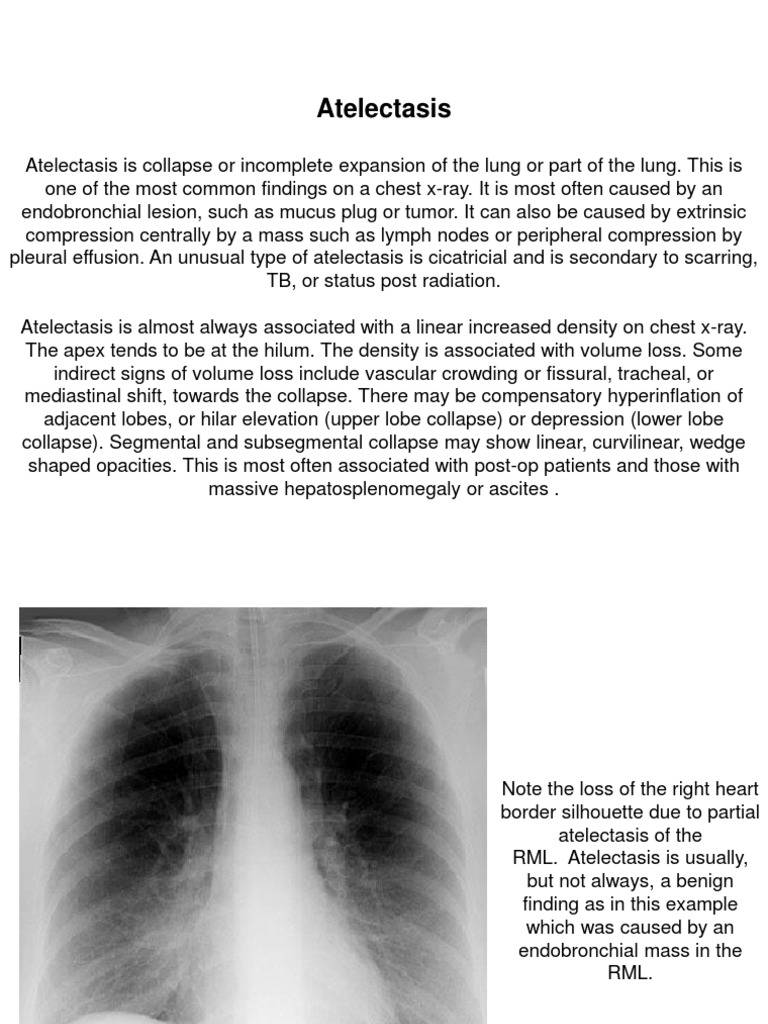 A Comprehensive Guide to Identifying and Understanding Atelectasis on ...