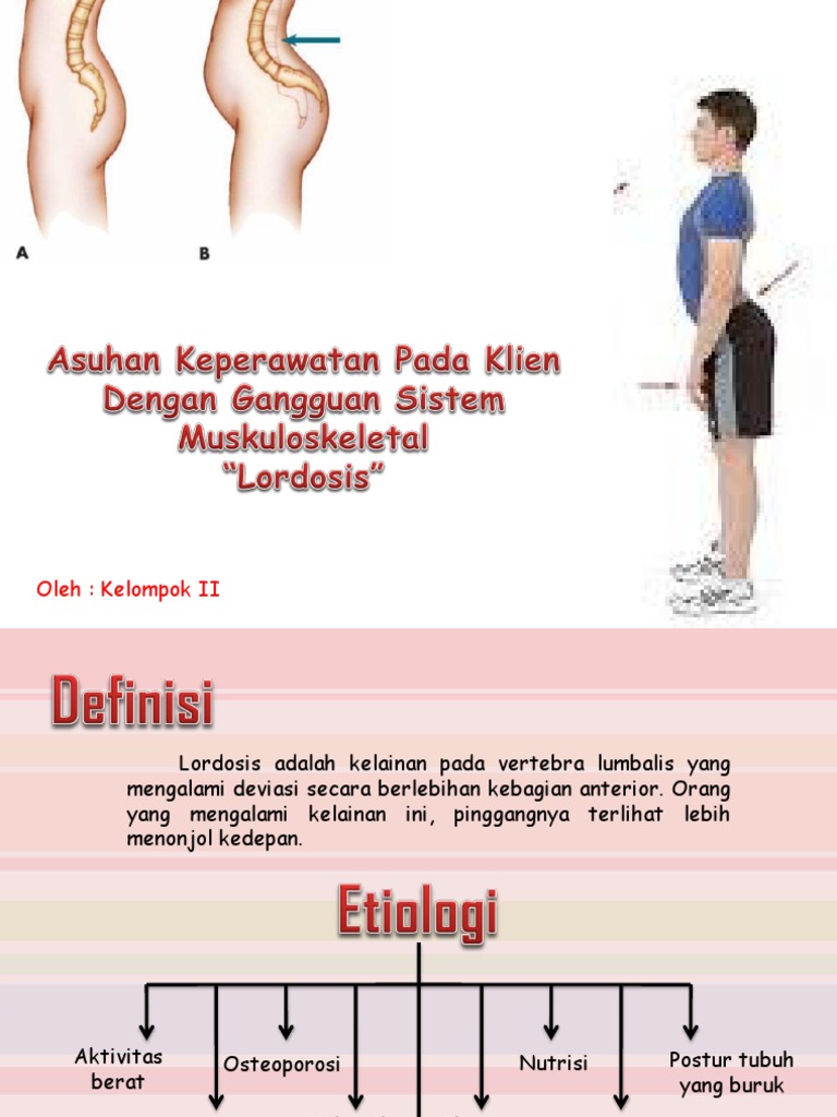 Lordosis | PDF