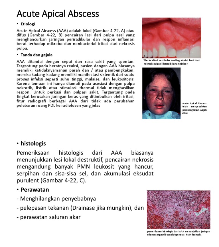 Akut Apical Abses | PDF