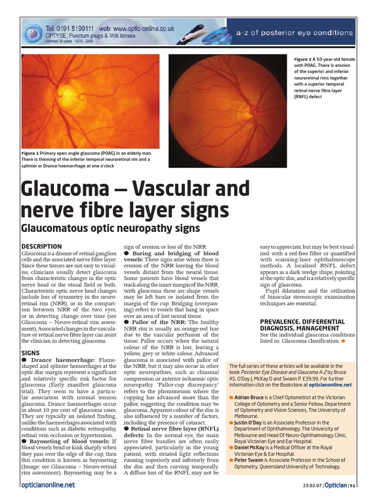 Funduscopy in Glaucoma | PDF | Glaucoma | Retina
