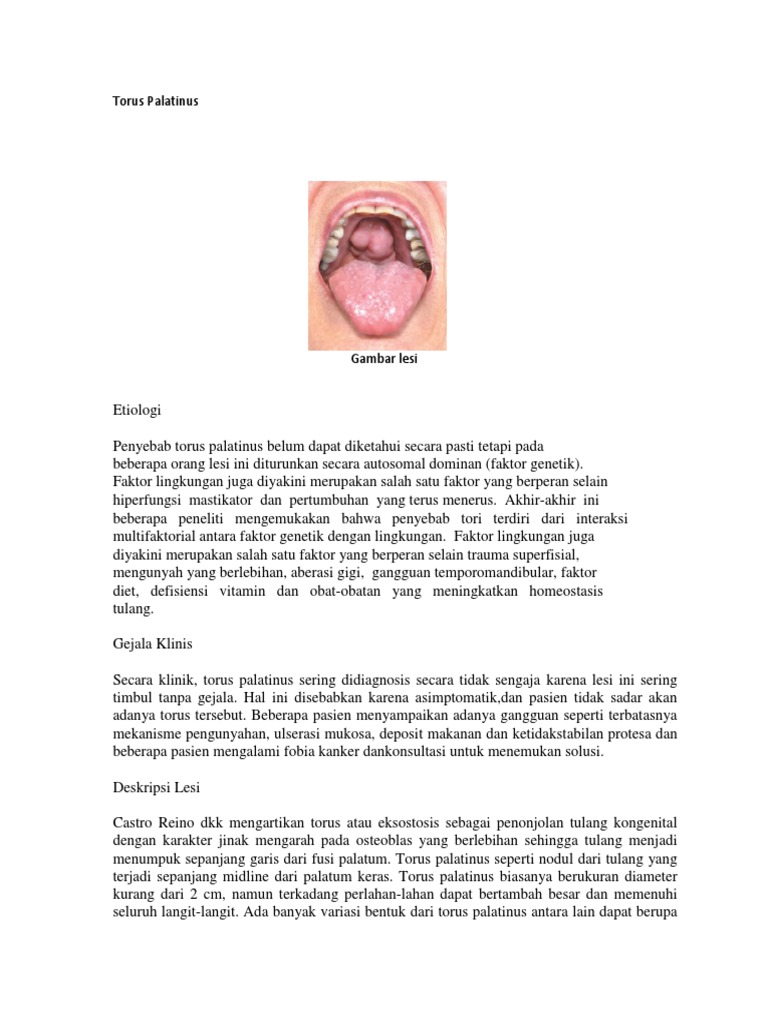 Torus Palatinus | PDF