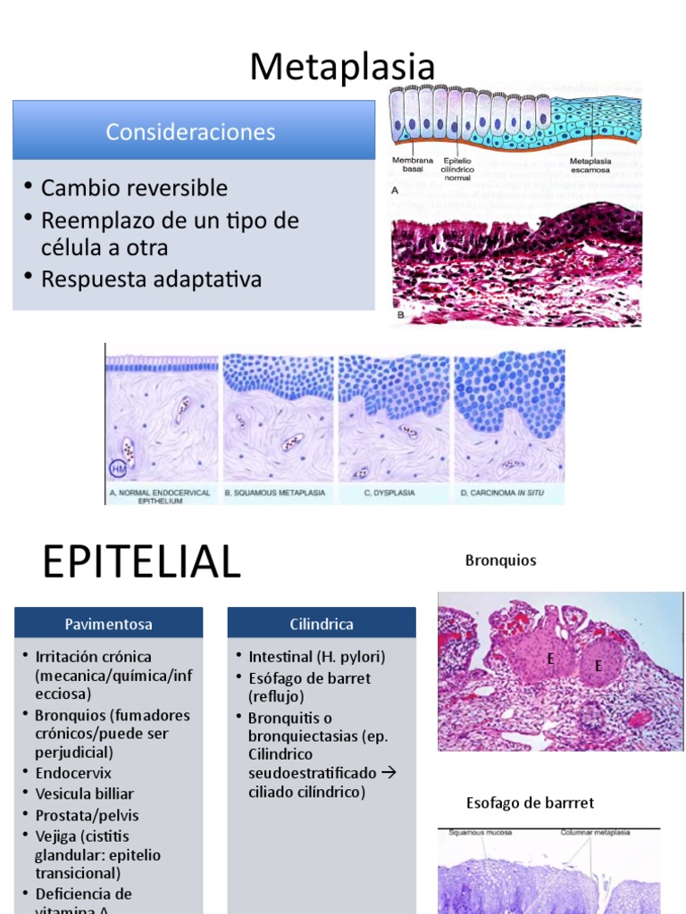 Metaplasia | PDF