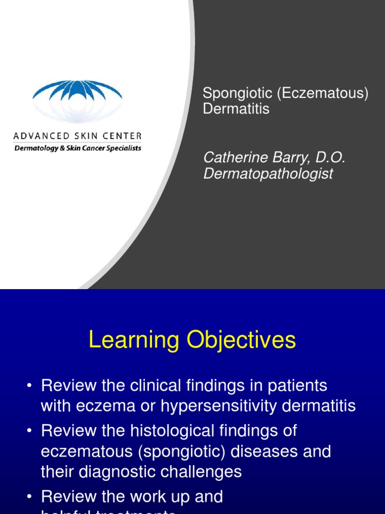 Understanding Spongiotic Dermatitis: A Review of the Clinical and ...
