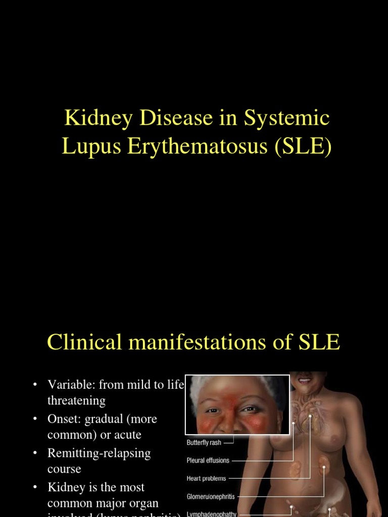 Kidney Disease in Systemic Lupus Erythematosus (SLE) | PDF | Systemic ...