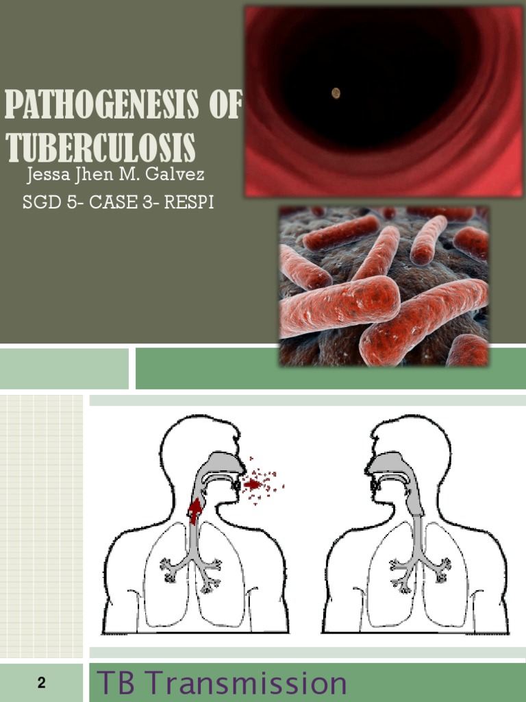 Pathogenesis of TB - Jessa Jhen Galvez | PDF | Tuberculosis | Macrophage