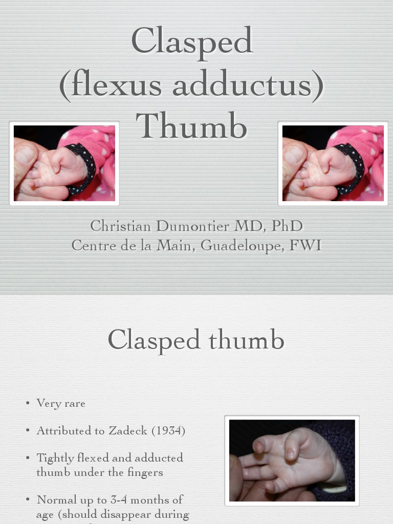 Clasped (Flexus Adductus) Thumb: Christian Dumontier MD, PHD Centre de ...