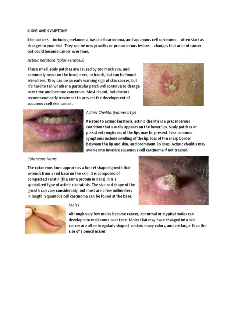 Skin Cancer Signs and Treatment | PDF | Skin Cancer | Cancer