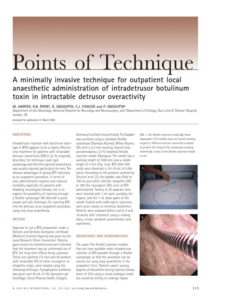 A Minimally Invasive Technique For Outpatient Local Anaesthetic ...