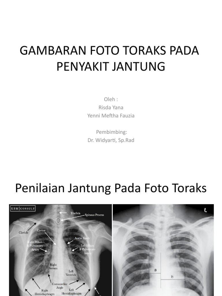 Gambaran Foto Toraks Pada Penyakit Jantung | PDF