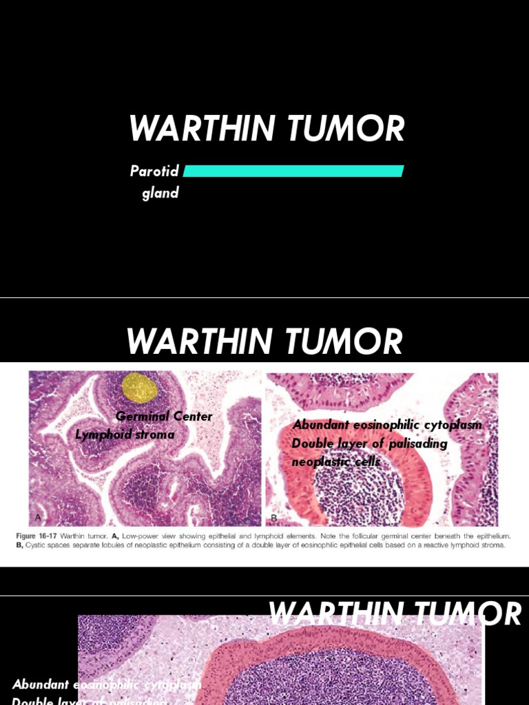 Wartin Tumor Presentation | PDF