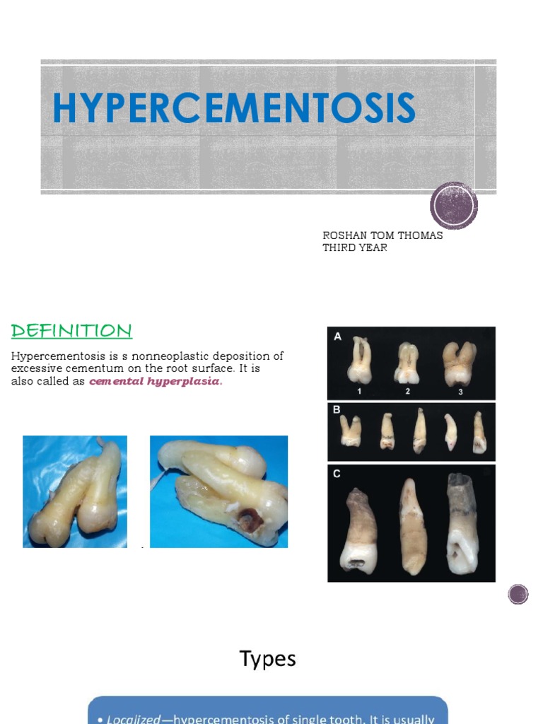Hyper Cementosis | PDF | Dental Anatomy | Human Tooth