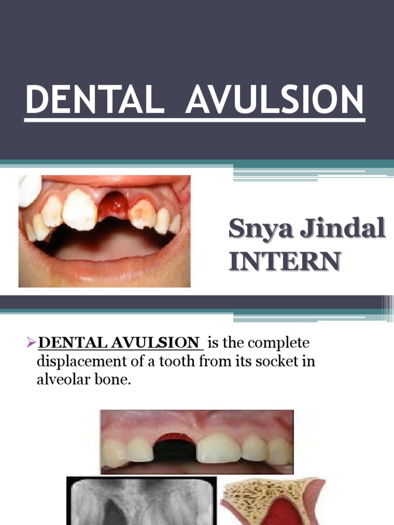Dental Avulsion