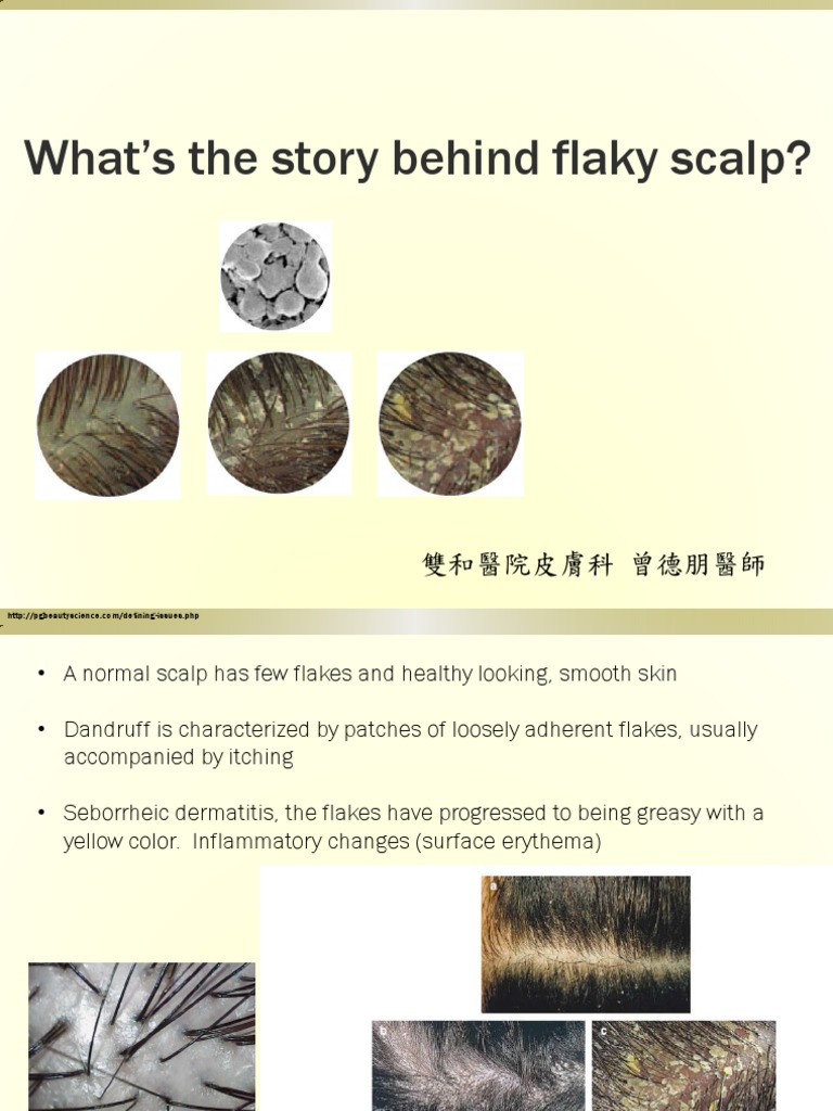 Understanding Dandruff & Scalp Health | PDF | Dermatitis | Shampoo